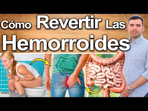Cómo Curar Las Hemorroides Internas - Causas, Remedios Y Soluciones - YouTube