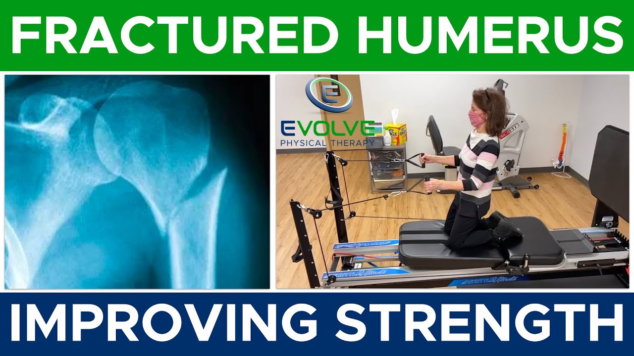 Fractured Humerus | Improving Strength | Part 2 - YouTube