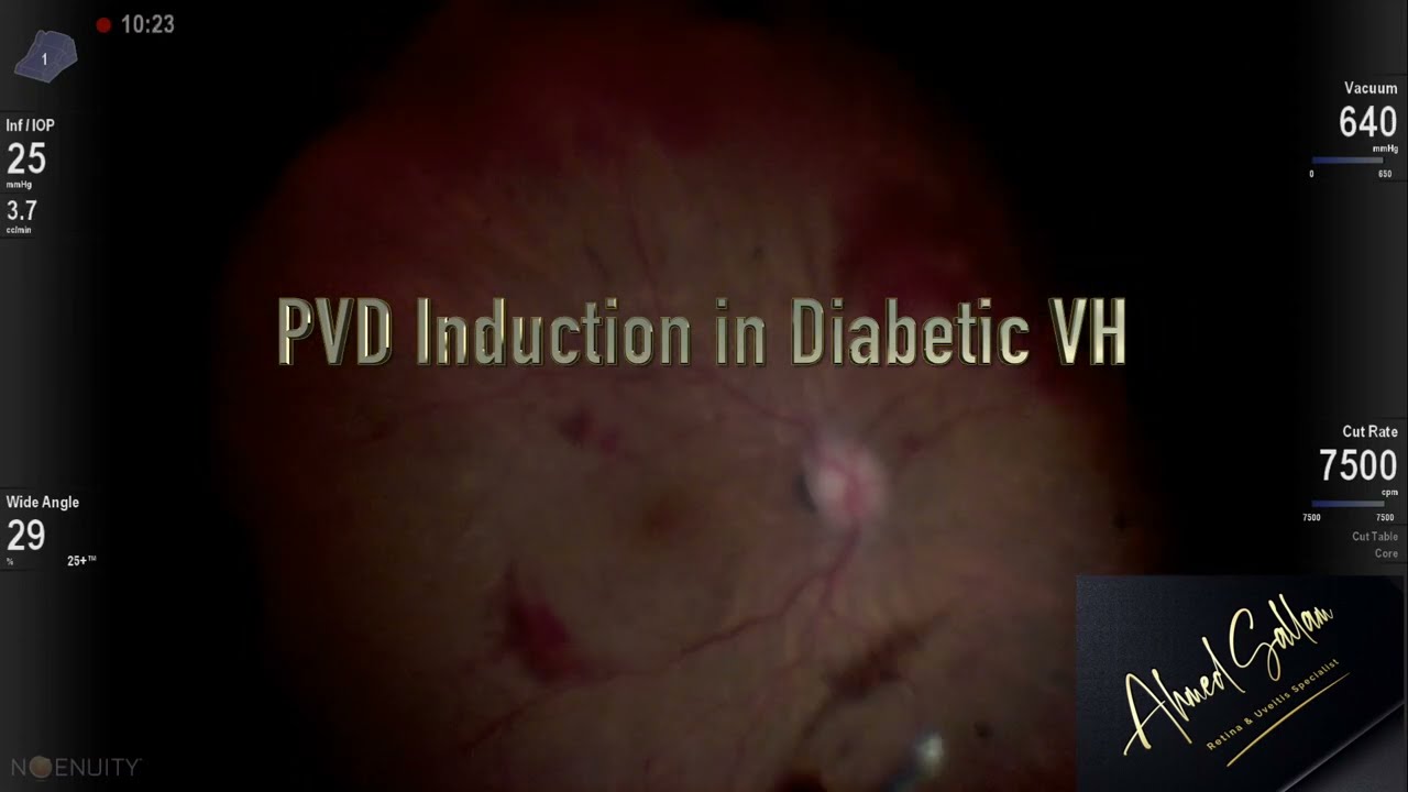 PVD induction in diabetic vitreous hemorrhage - YouTube