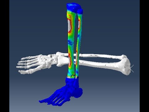 Fracture simulation骨折模拟效果I'll kick you a fracture - YouTube
