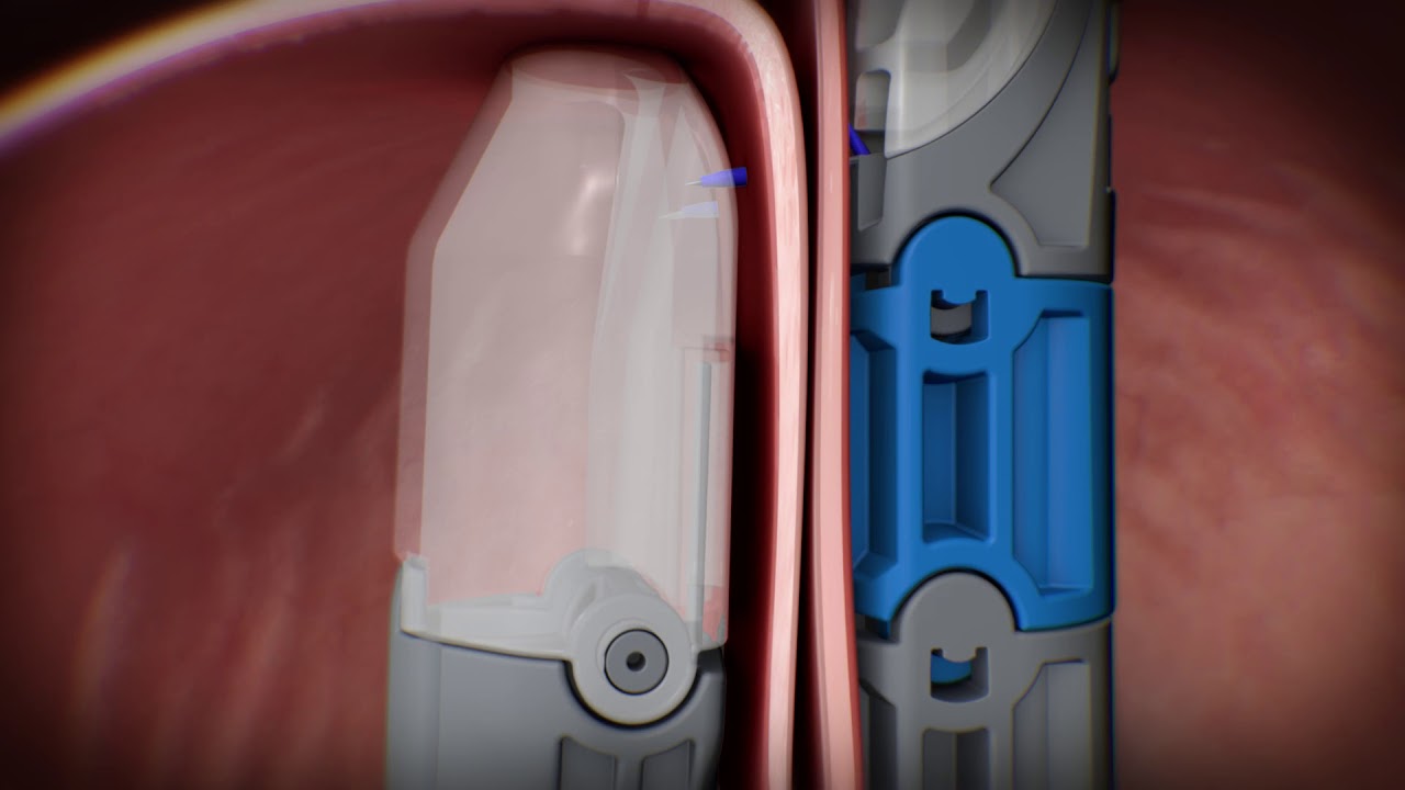 TIF Procedure with EsophyX® Device | Dr. Anthony Pozzessere in Ramsey ...