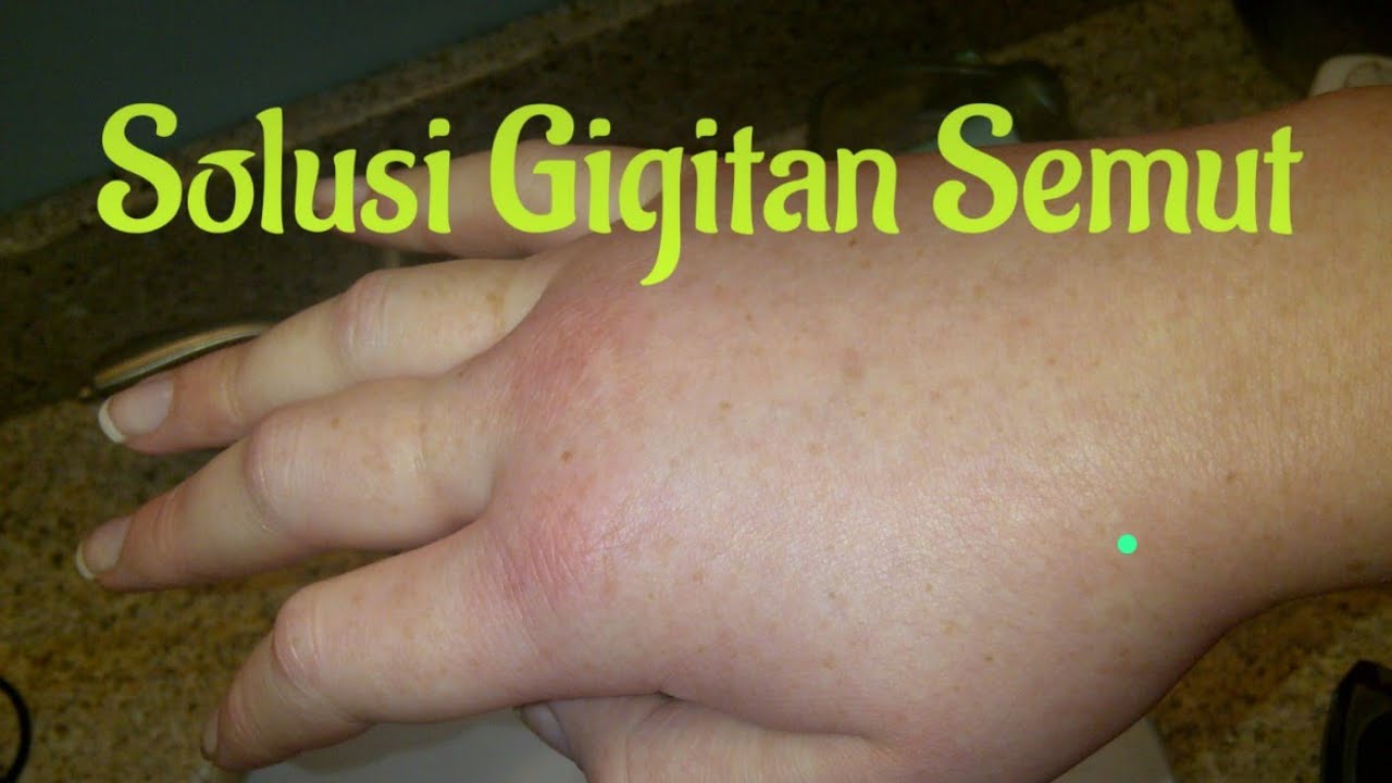 Cara Mengobati Bengkak Akibat Gigitan Serangga Semut Hitam, Mengatasi ...