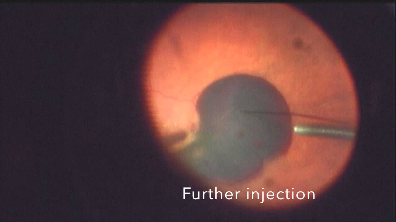 Submacular Tpa for large sub macular bleed in wet AMD - YouTube