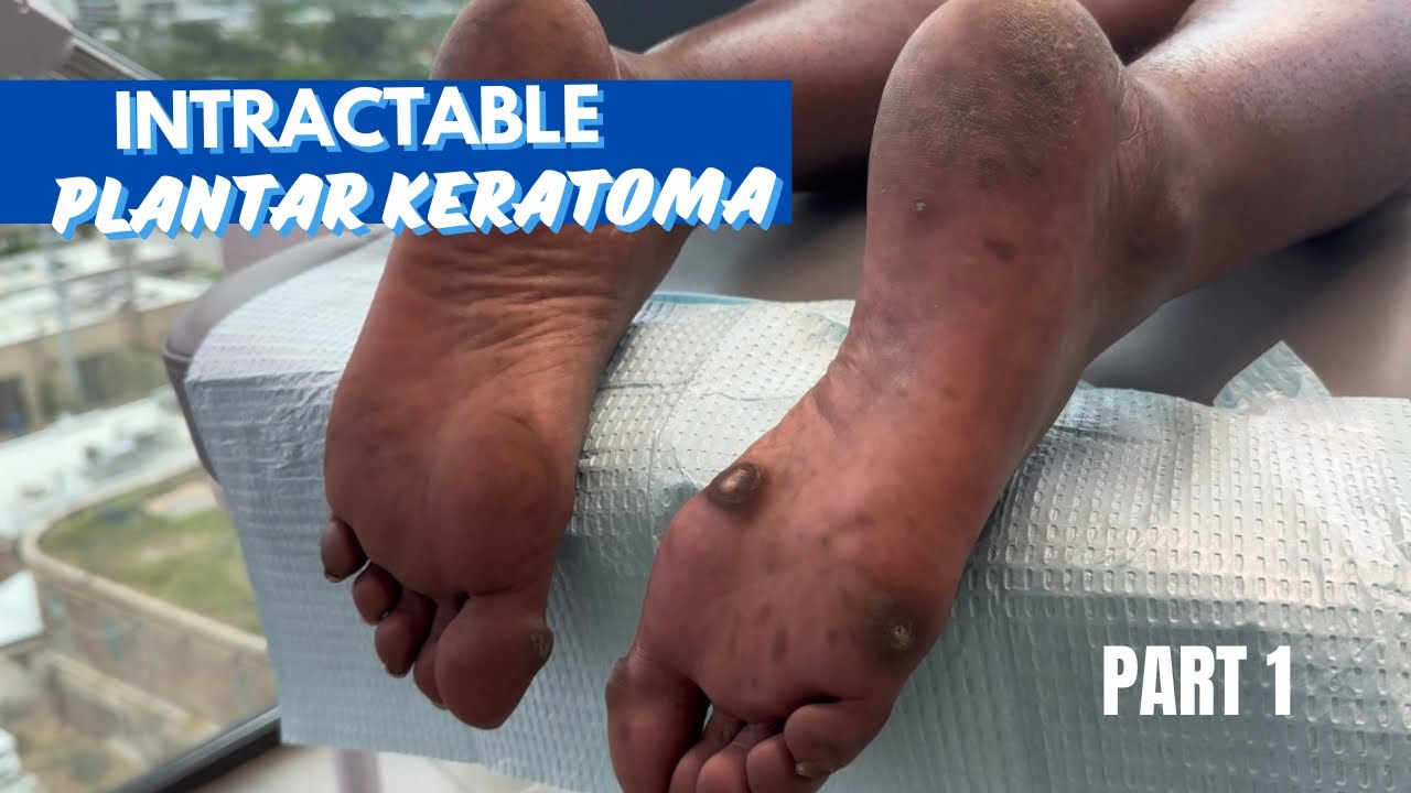 SATISFYING “FISH EYE” REMOVAL 🦶🏽🧿 (IPK) / PART 1 - YouTube