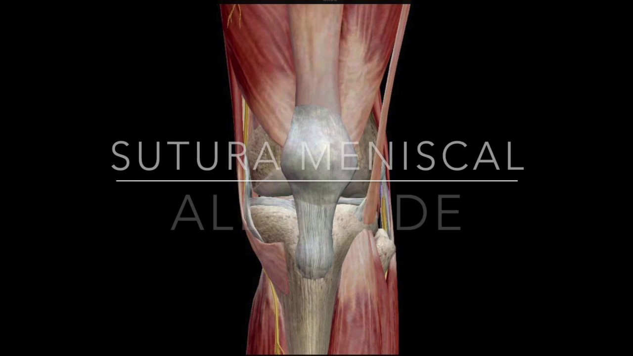 Sutura Meniscal. ALL INSIDE . - YouTube
