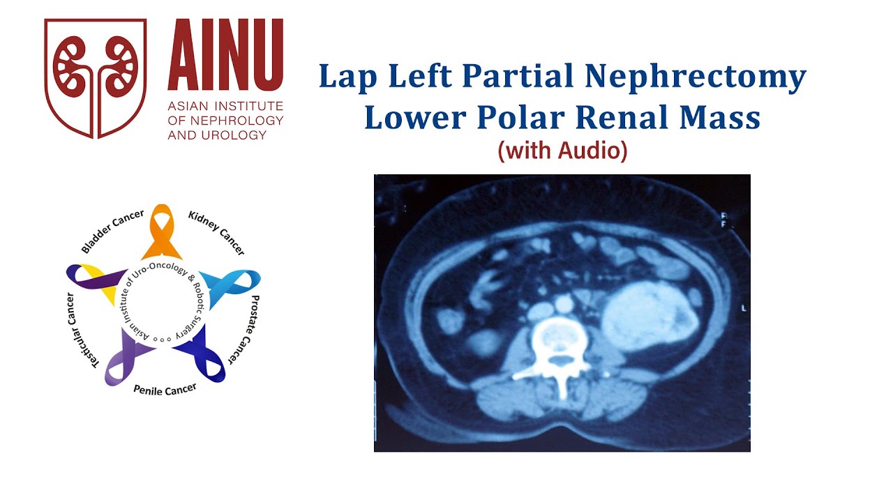 Lap Left Partial Nephrectomy Lower polar renal mass (with Audio ...
