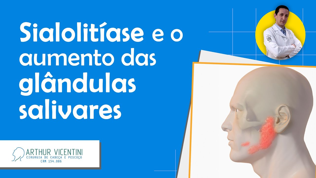 Sialolitíase e o aumento das glândulas salivares | Dr. Arthur Vicentini ...