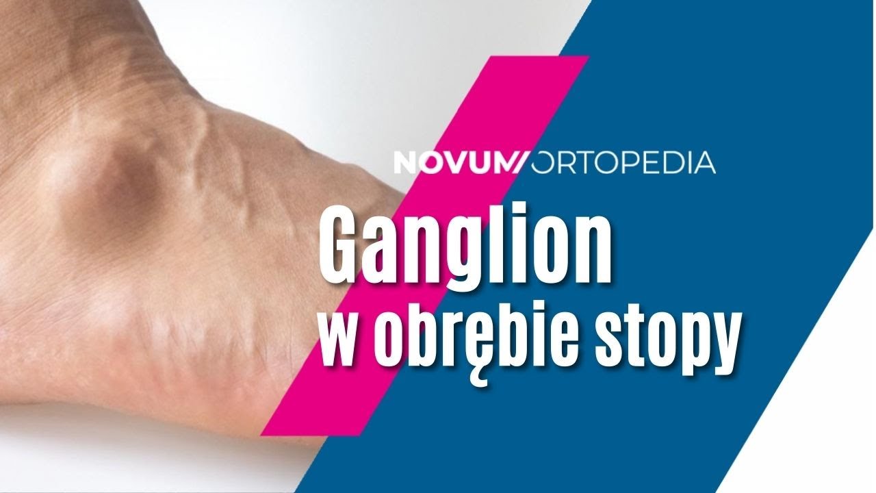 Ganglion: czym jest i jak sobie z nim poradzić | Novum Ortopedia - YouTube