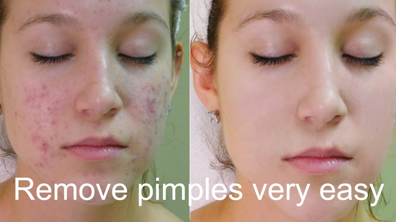 How To Remove Pimples In Photoshop Very Easy YouTube how-to-remove-pimples-in-photoshop-very-easy-youtube