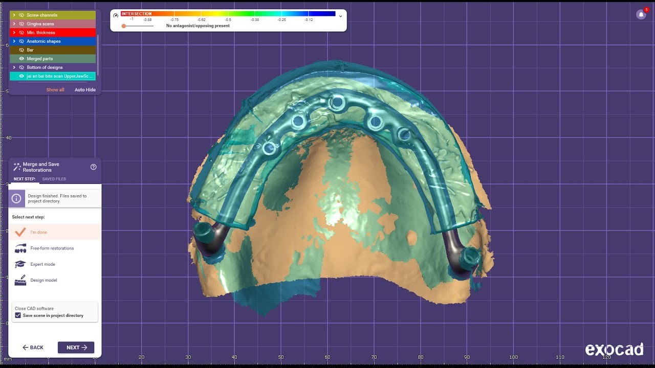 Upper all on 7 titanium bar designing for screw retained implant in ...