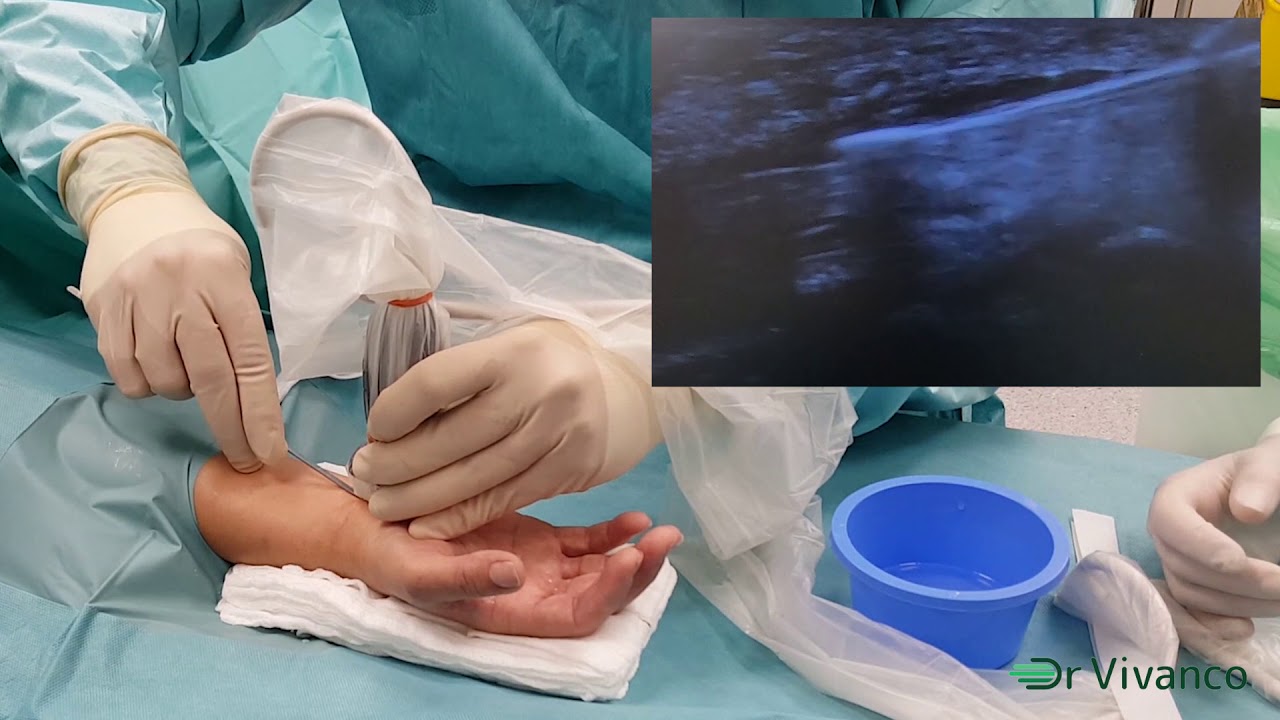 Ultra Minimally Invasive Ultrasound-Guided WALANT Carpal Tunnel Release ...