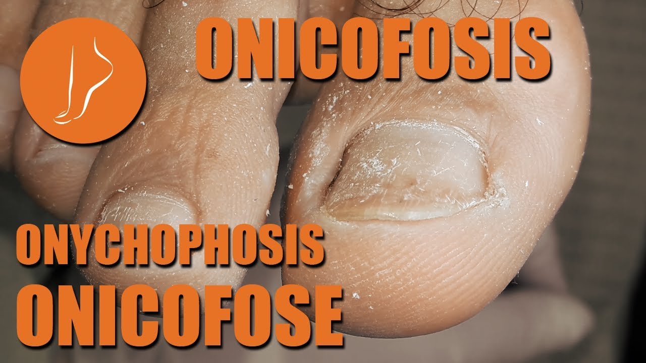 Onicofosis lateral #podologiaintegral - YouTube