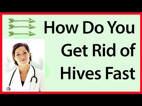 How To Get Rid of Hives Fast - Top 3 Natural Ways - YouTube