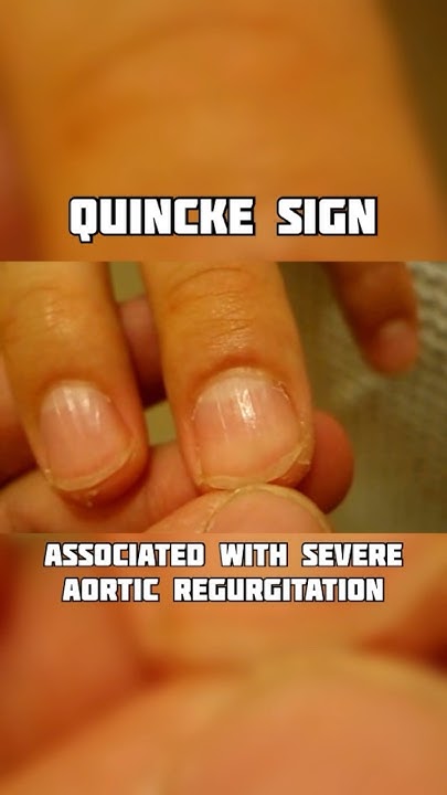 Quincke’s Sign in Aortic Regurgitation - YouTube