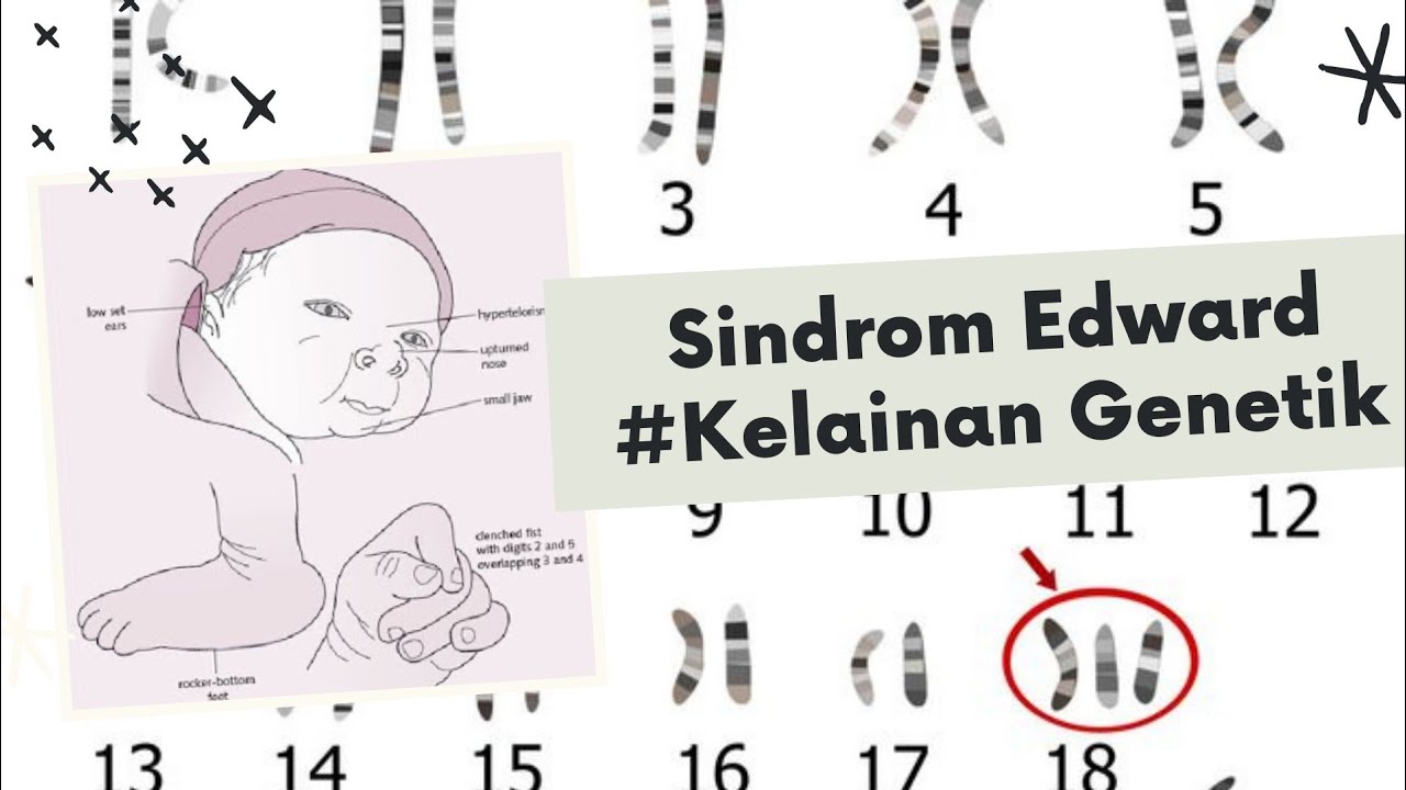 Mengenal Sindrom Edwards - YouTube