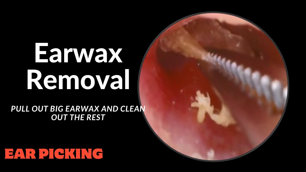 Satisfying big earwax pull out and ear canal cleaning - Nia v47 - YouTube