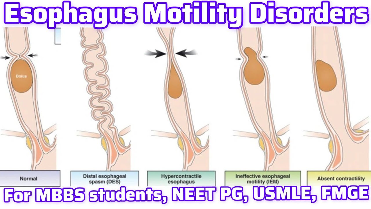 esophageal-motility-disorder-for-mbbs-students-neet-pg-usmle-fmge-i