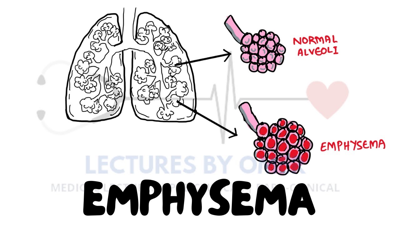 Emphysema | COPD in Under 20 Minutes | Pathology | Lectures by Omer ...