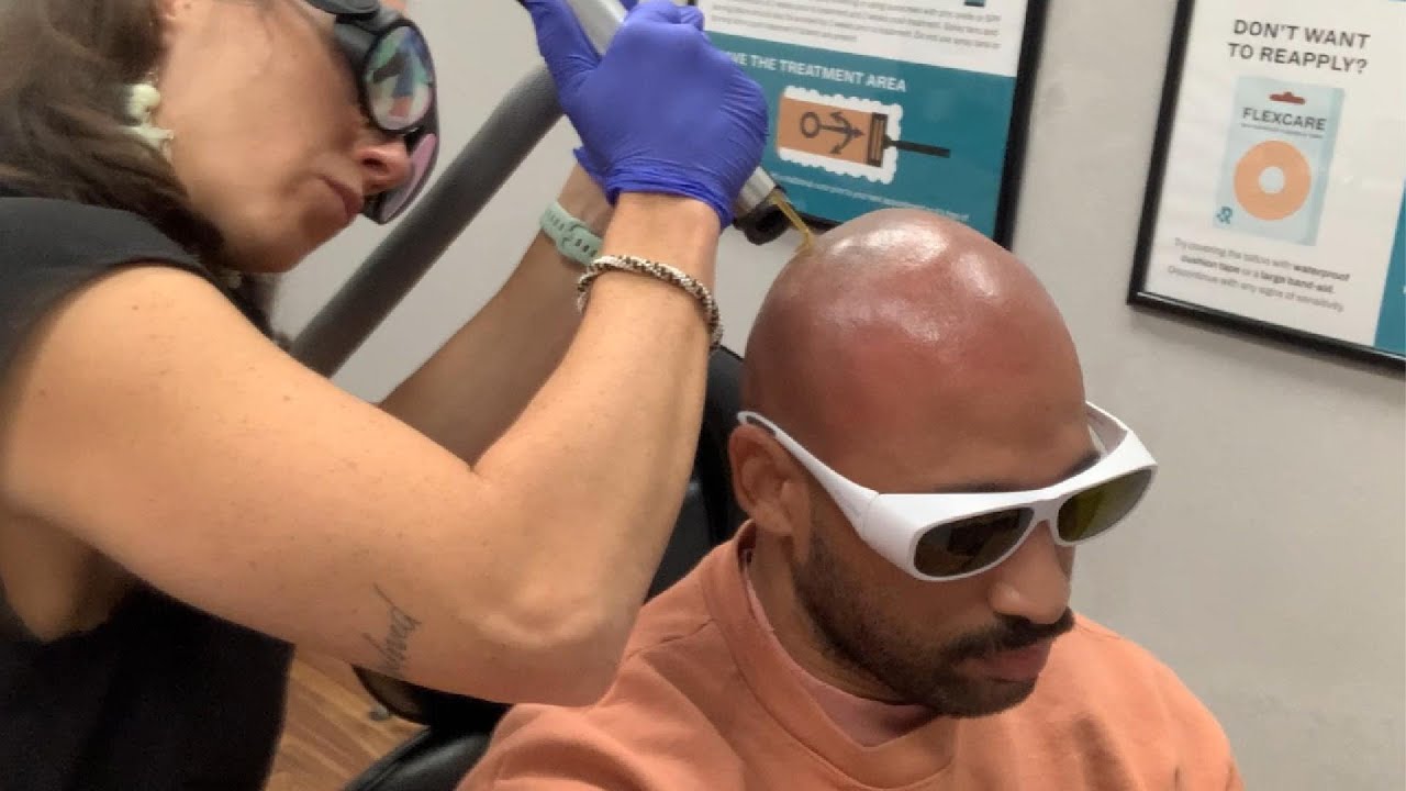Laser REMOVING my Scalp Micro Pigmentation (SMP) Part. 2 (Vlog) - YouTube