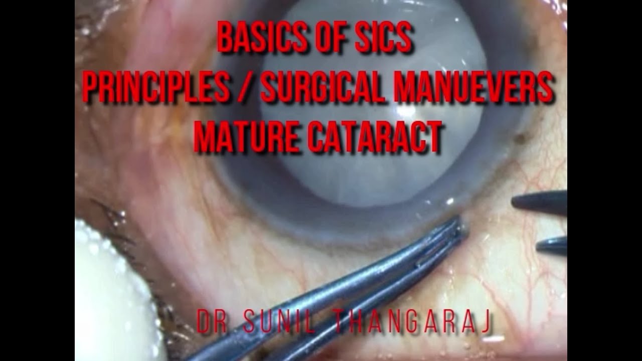 Basics of SICS - Surgical principles and maneuvers - YouTube