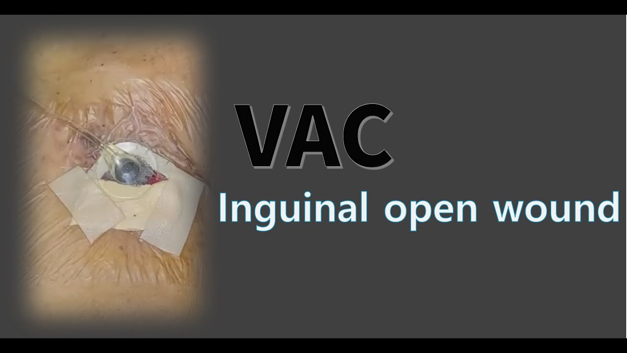 VAC (Vacuum-Assisted Closure) for Inguinal open wound - YouTube