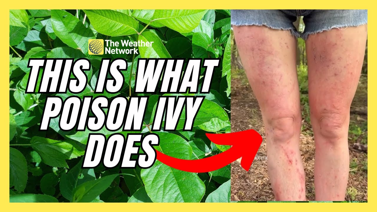 Gardener Discovers Poison Ivy's Terrible Effects The Hard Way - YouTube