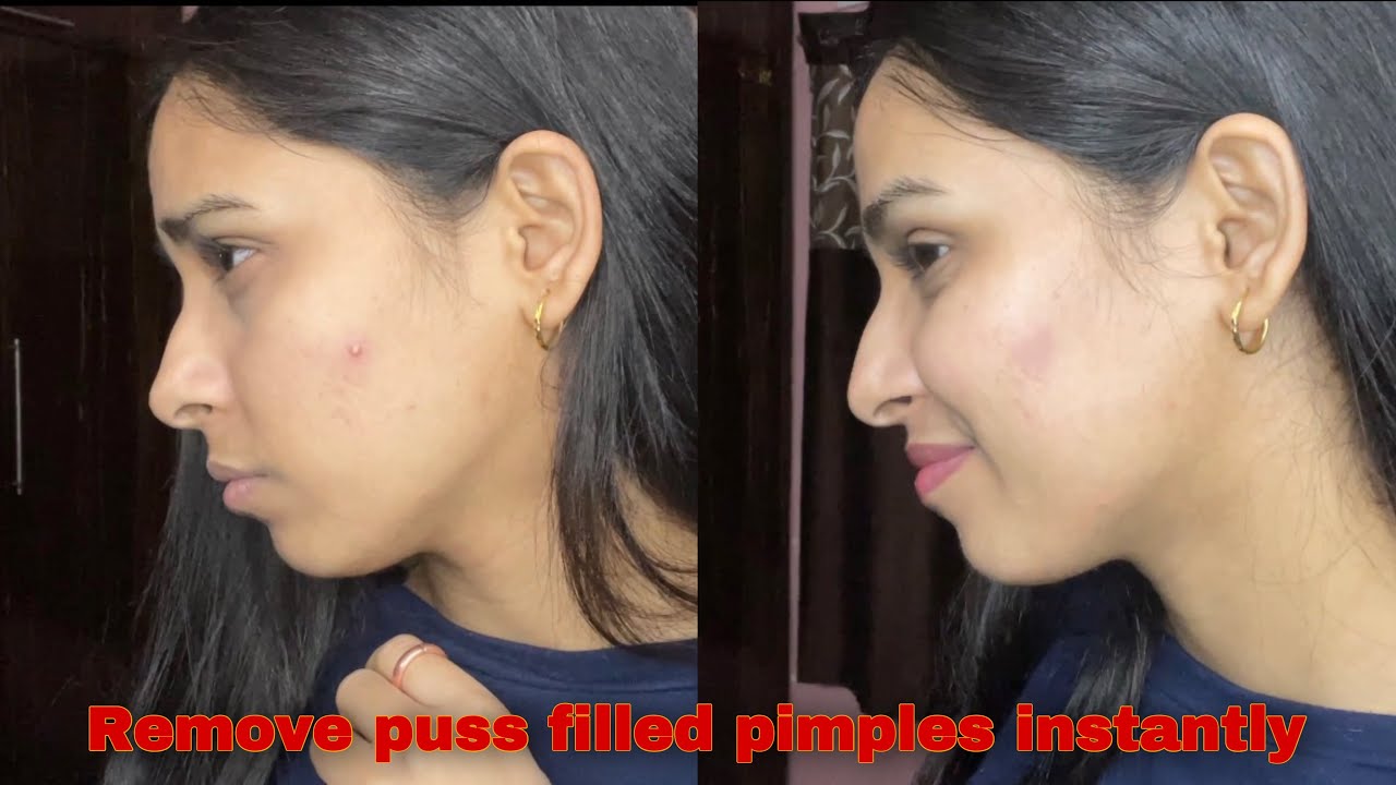 Get rid of puss filled pimples instantly - YouTube