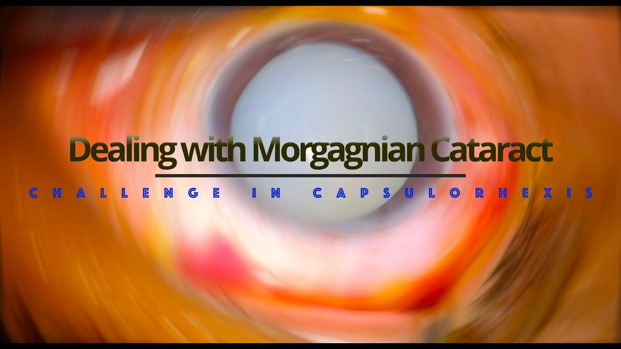 MIIQ 66: Cataract Surgical Step | Capsulorhexis 3: Morgagnian Cataract ...