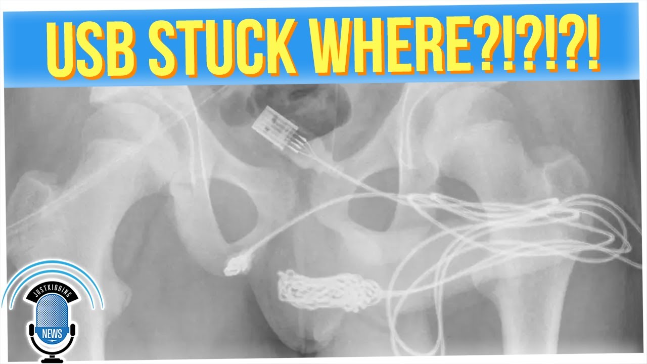 Teenager Hospitalized After a USB Cable Got Stuck in His Body - YouTube
