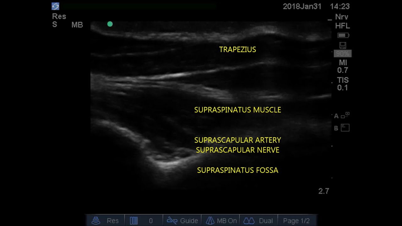 USG GUIDED SCREENING FOR SUPRASCAPULAR NERVE BLOCK - YouTube