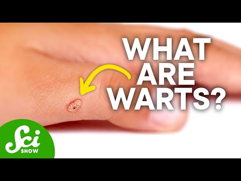 What Do Frog Warts Look Like
