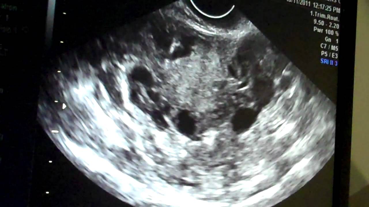 Baby #2 Ultrasound - 9 weeks 5 days. - YouTube