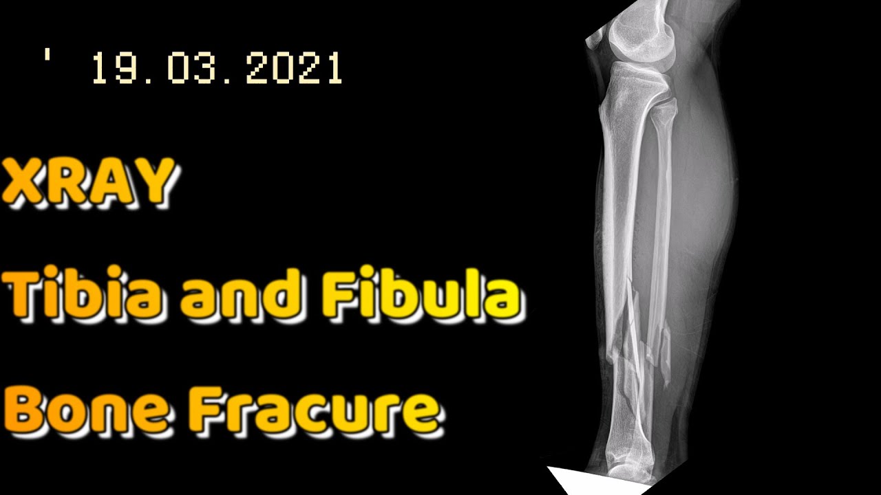 Xray - Tibia and Fibula x-ray update - YouTube