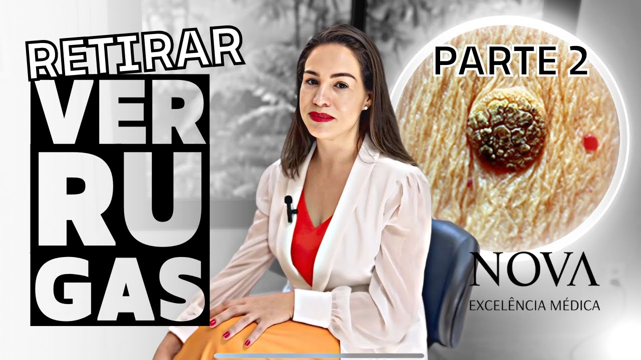 VERRUGAS - Como retirar? Parte 2 #verrugas #queratose - YouTube