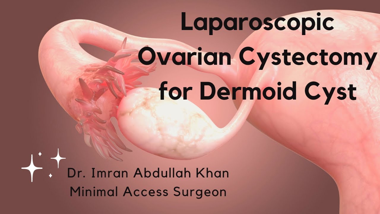 Laparoscopic Ovarian Cystectomy Dermoid Cyst Surgery Ovarian