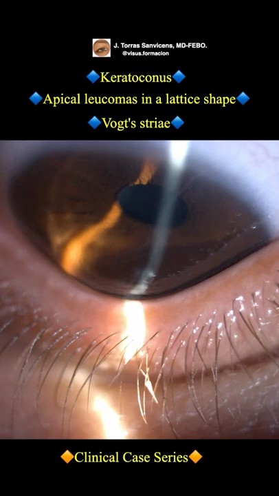 Keratoconus. Munson´s sign. Vogt's striae. - YouTube