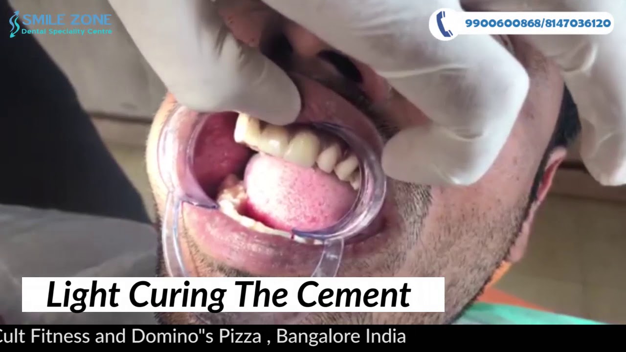 Dental Veneer Procedure Live - Dr Priya Verma - Best Dentist in ...