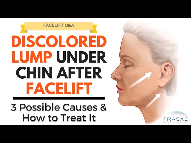Lump Under Chin