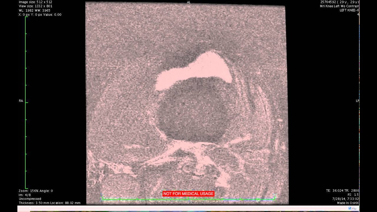 Knee MRI - AX PD FS - YouTube