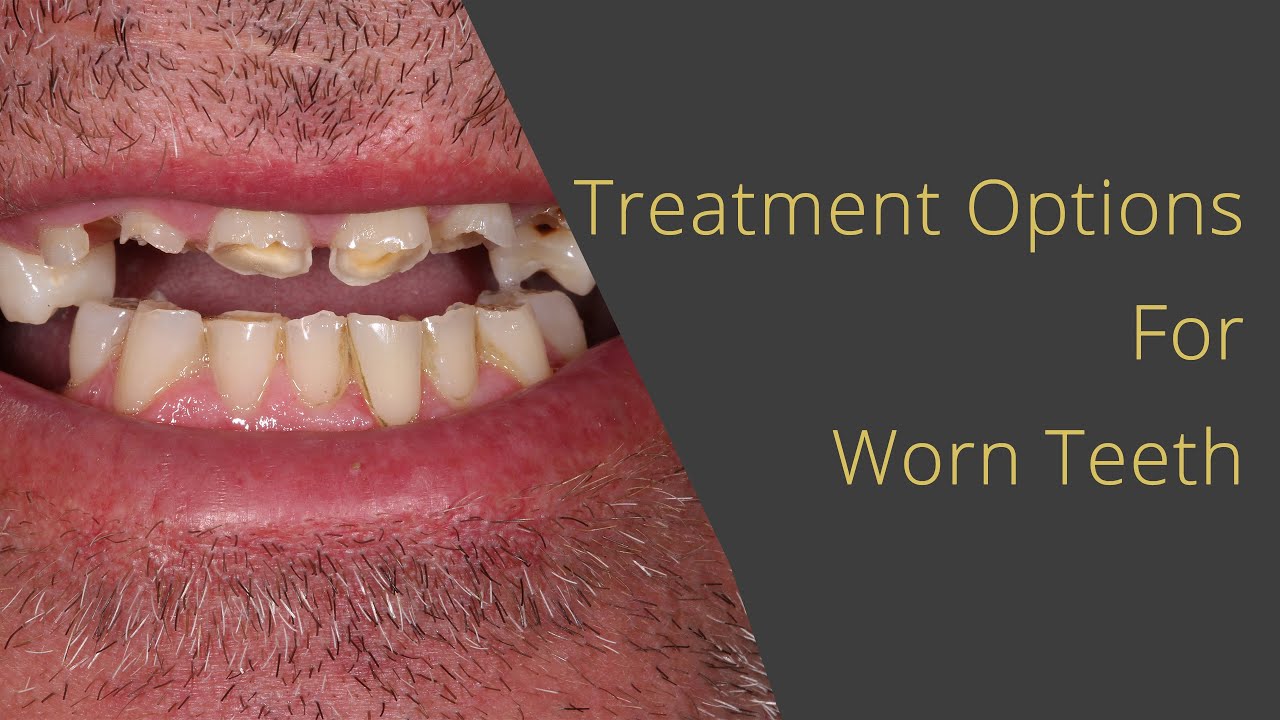 Worn Teeth - What You Can Do (and should you worry about thinning teeth ...