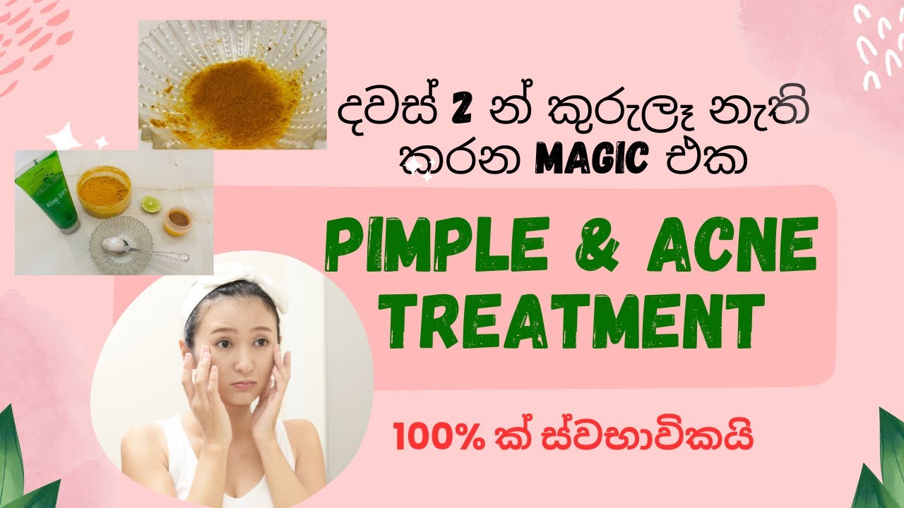 DIY Pimple and Acne Treatment | අමුද්‍රව්‍ය 4️⃣ කුරුලෑ සත්කාරය | දවස් ...