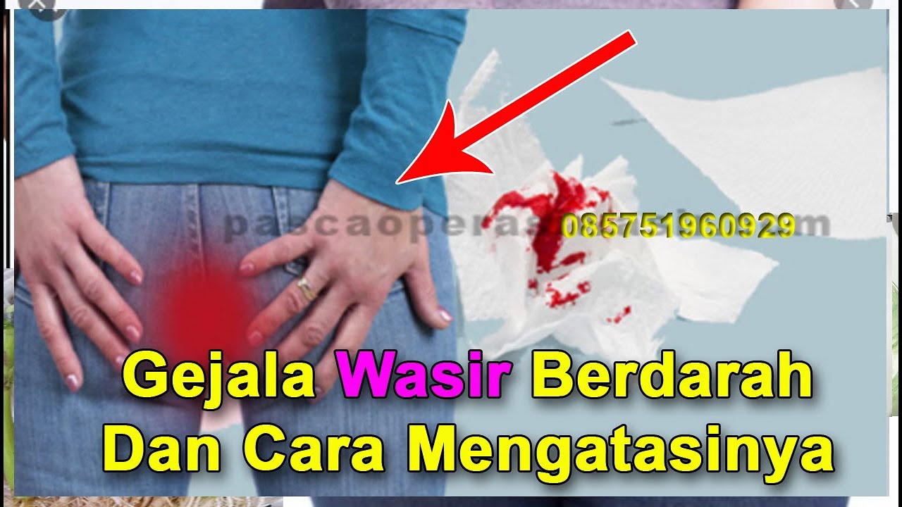 Gejala Wasir Berdarah Dan Cara Mengatasinya - YouTube