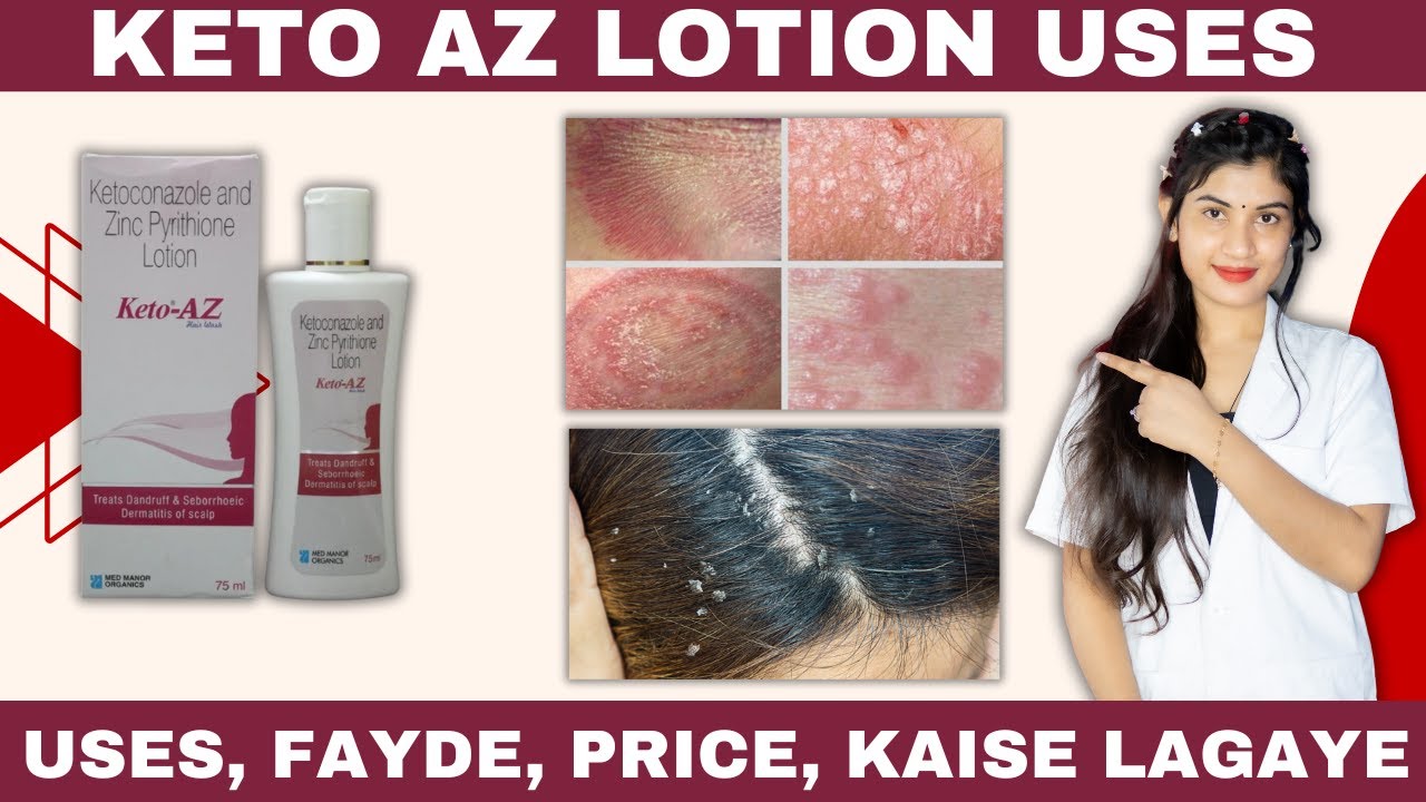 Ketoconazole and Zinc Pyrithione Lotion | Keto Az Lotion | Kaise Use ...