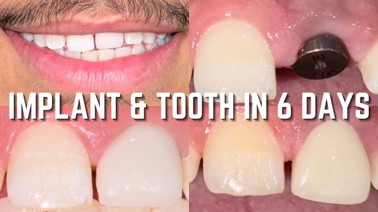 Front Upper Immediate Teeth Implant Procedure | Injury broken tooth ...