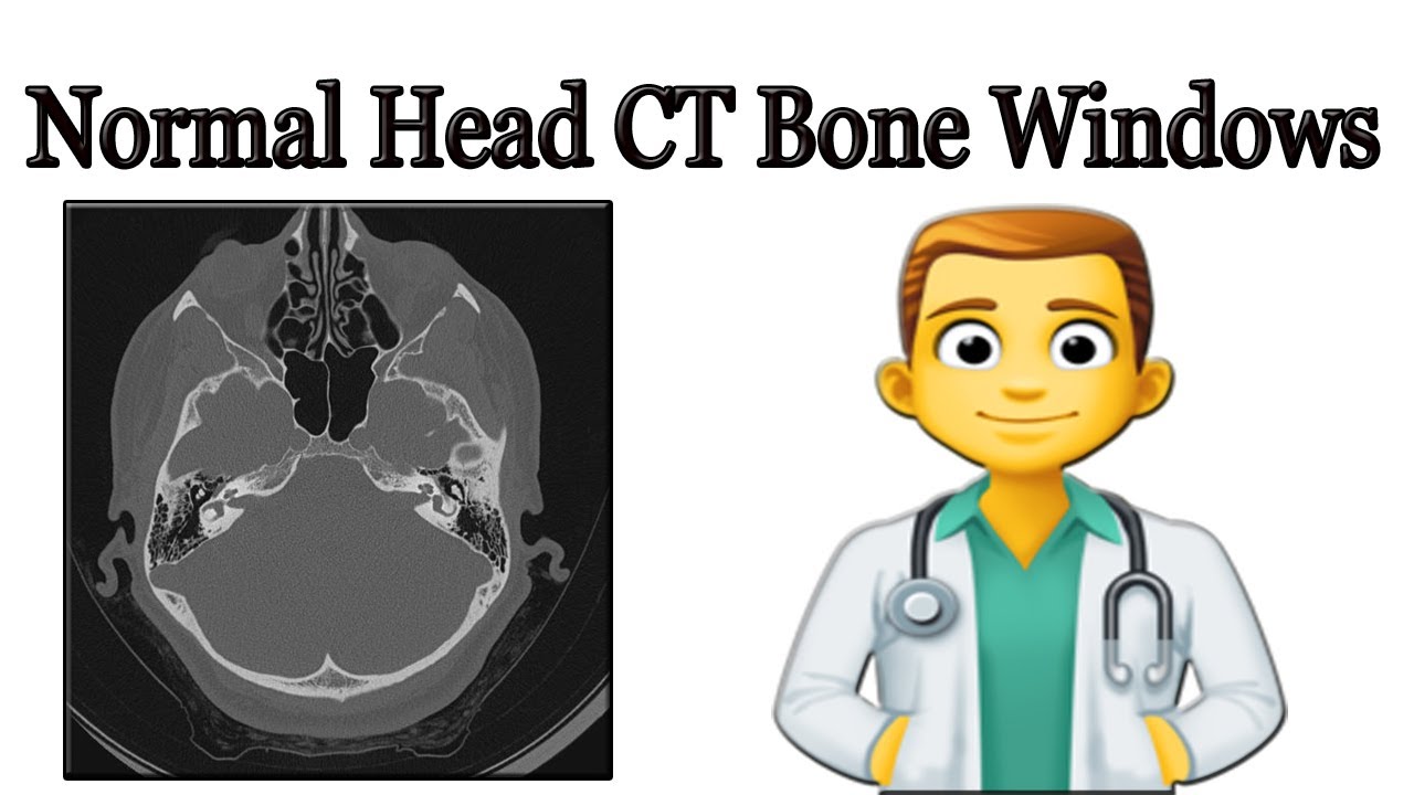 Normal head CT Bone windows - YouTube