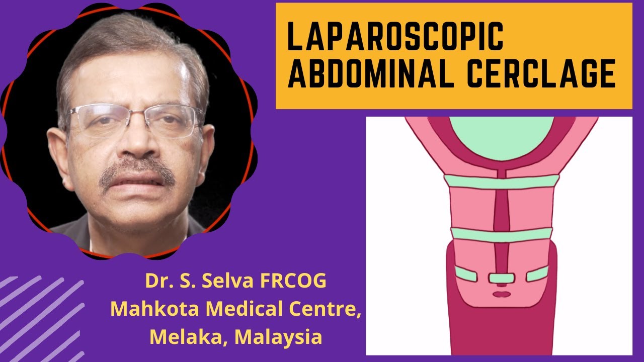 Laparoscopic abdominal cerclage - YouTube