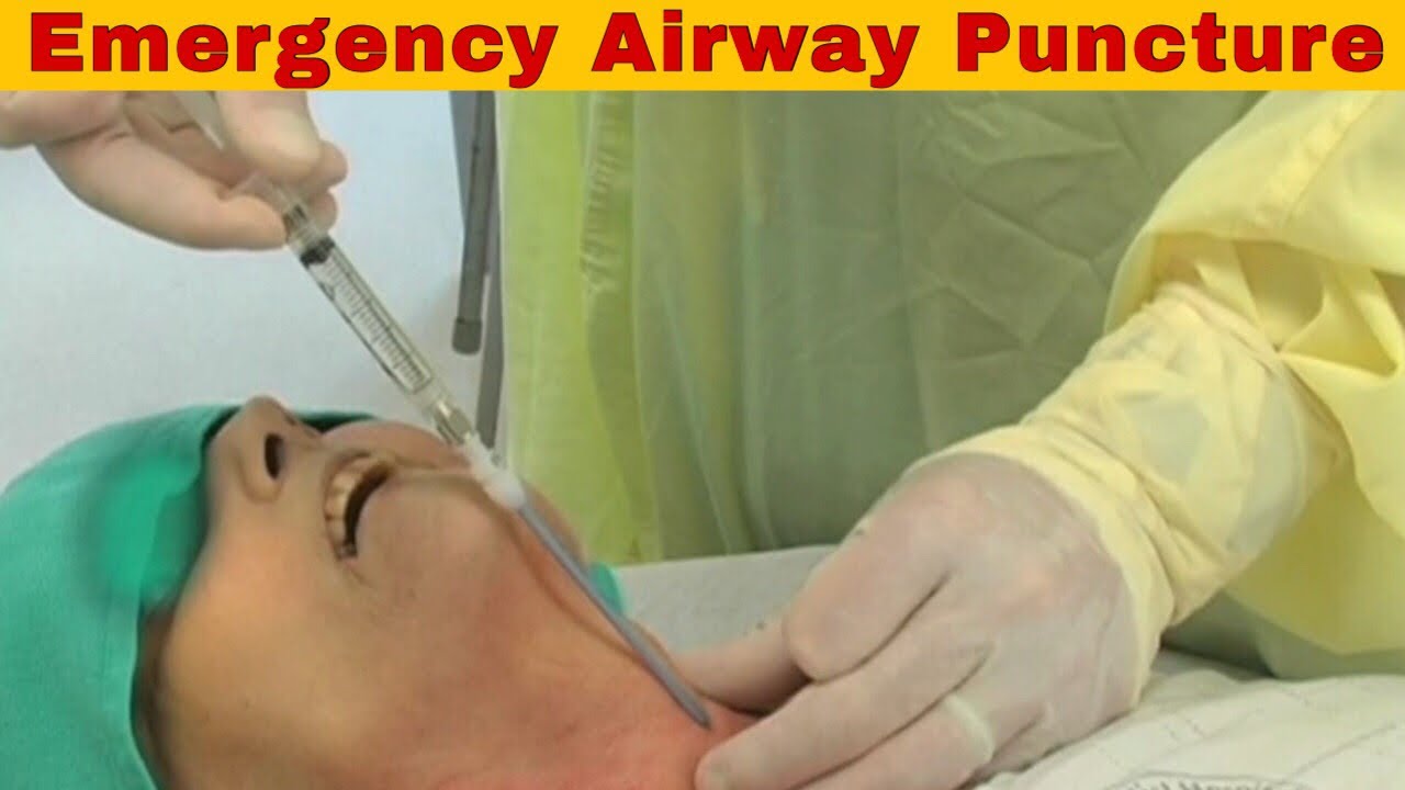 Needle Cricothyrotomy | EMERGENCY MEDICINE | Emergency Airway Puncture ...