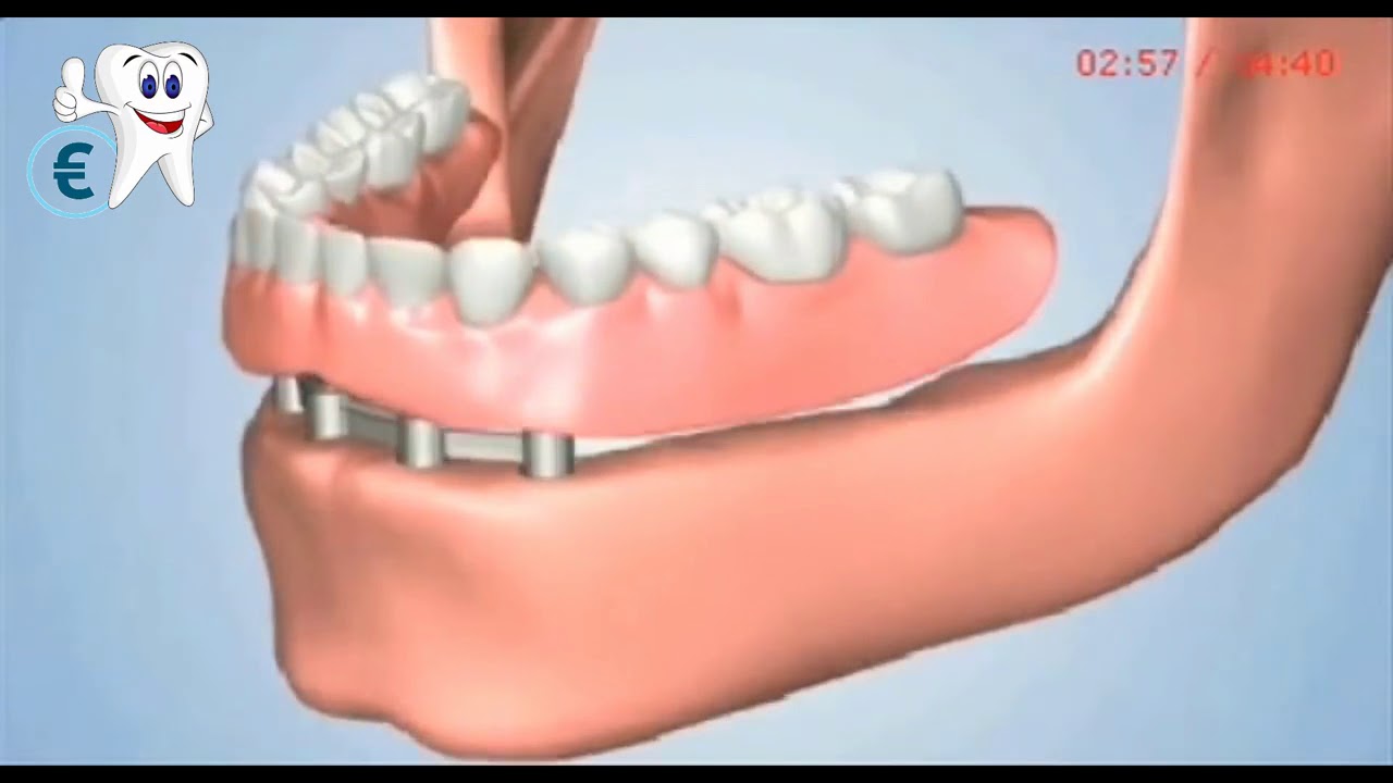 Protese de encaixe em implantes - YouTube