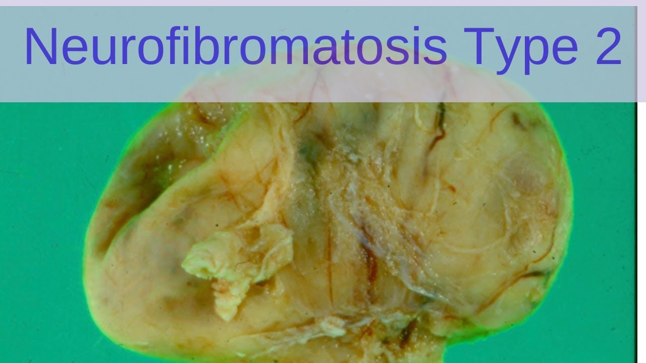 Neurofibromatosis Type 2 (NF2) - Pathology mini tutorials - YouTube