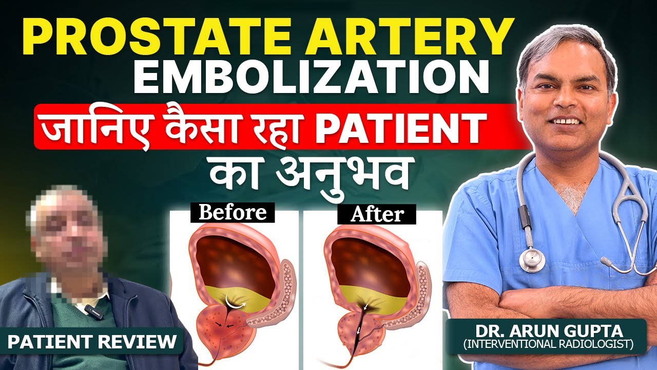 Prostate Artery Embolization (PAE) Patient Testimonial After Treatment ...